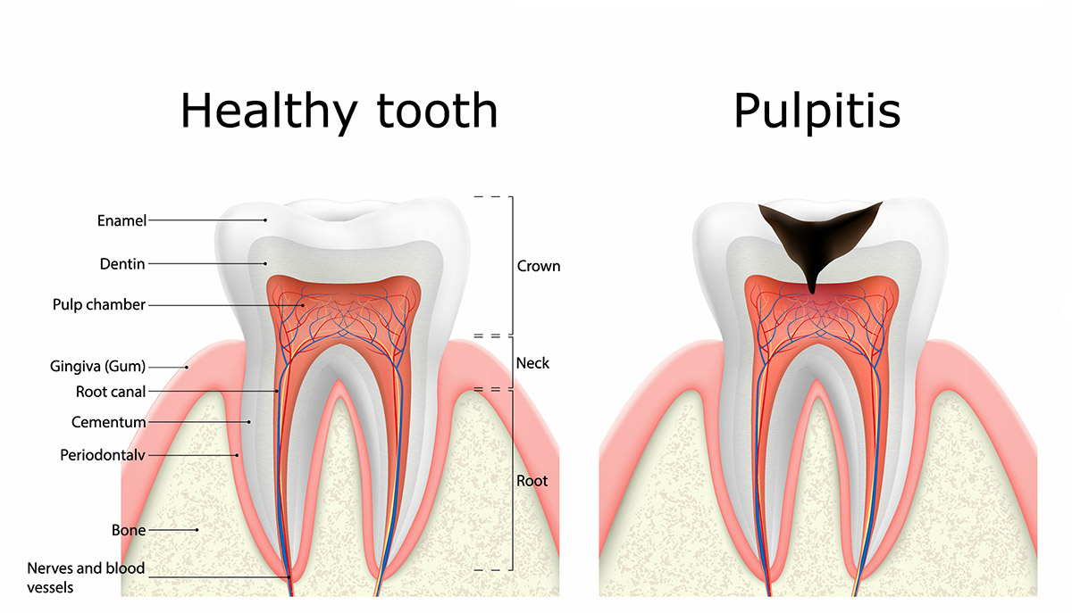 Tooth root inflammation: All about the symptoms and treatment of ...
